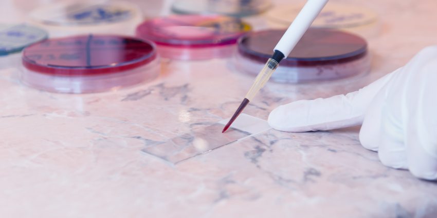 Sickle Cell Disease What Is It Nurse Advisor Magazine